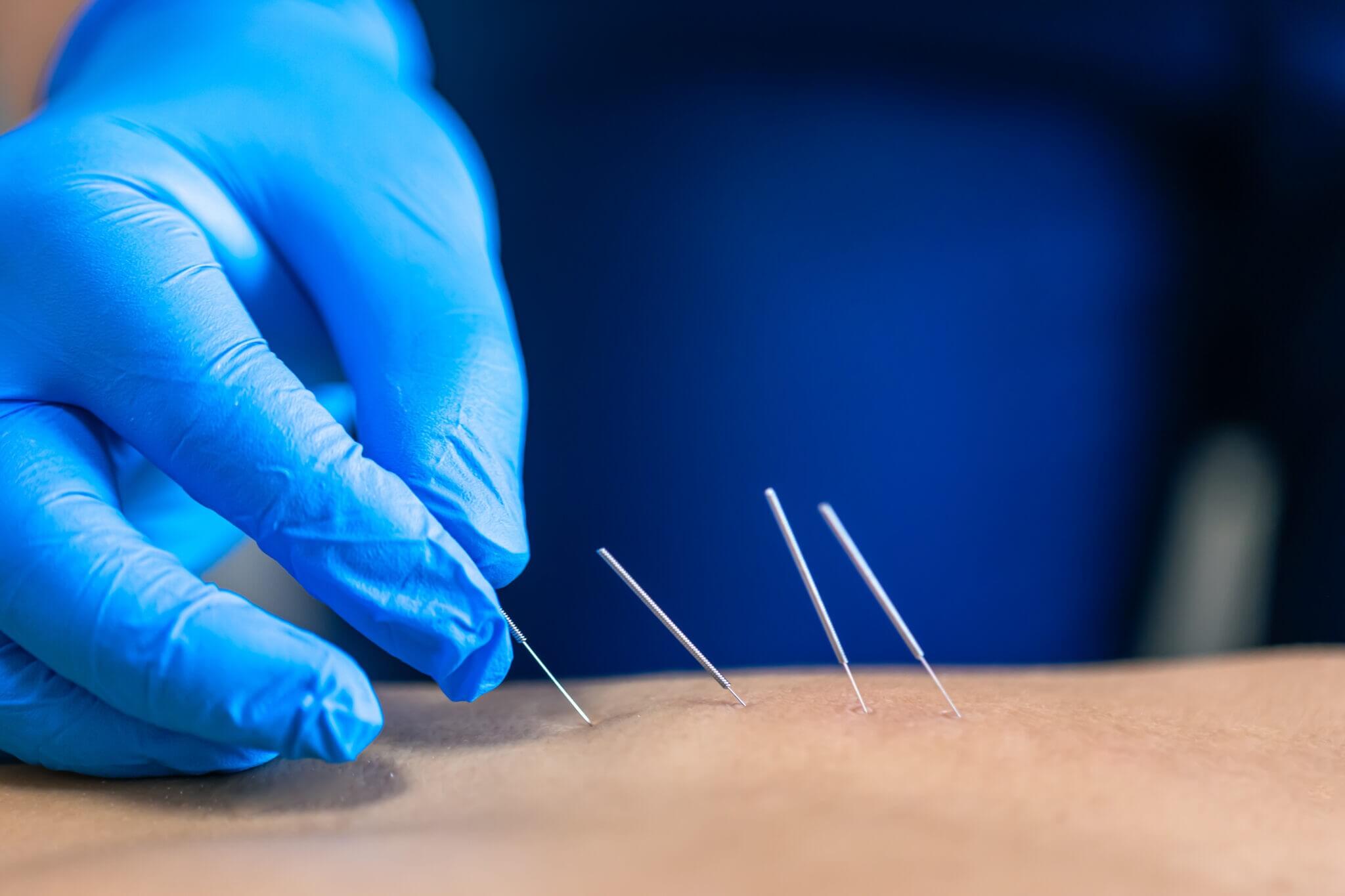 Effective Dry Needling Therapy for Pain Relief | Bull City PT